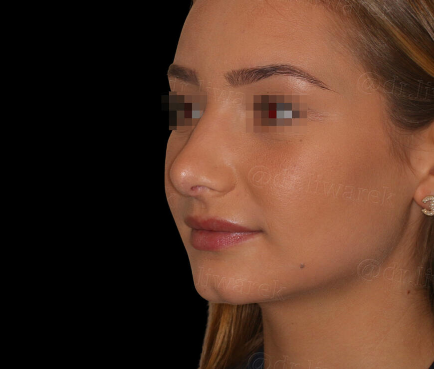 Les photos avant après de Rhinoplastie Primaire - Dr. Stéphane Liwarek